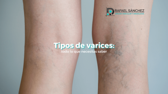 Tipos de varices: todo lo que necesitas saber - Doctor Rafael Sánchez