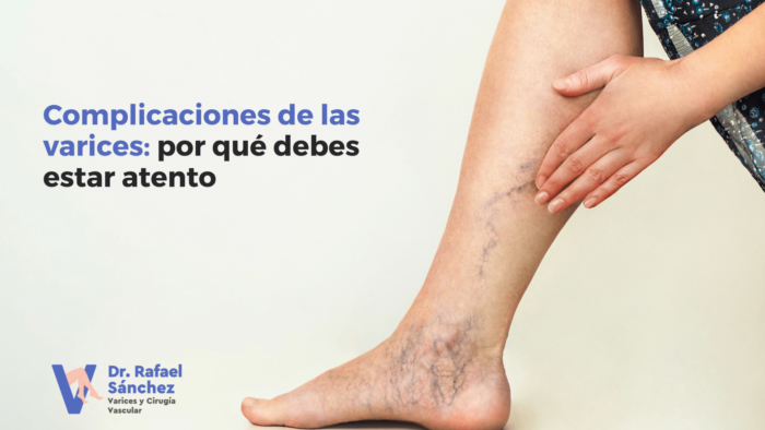 Complicaciones más comunes de las varices | Dr Rafael Sánchez
